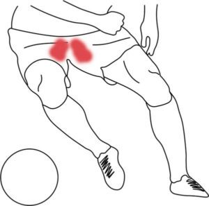 Pubalgie - Ostéopathe à Paris 13 et Paris 15