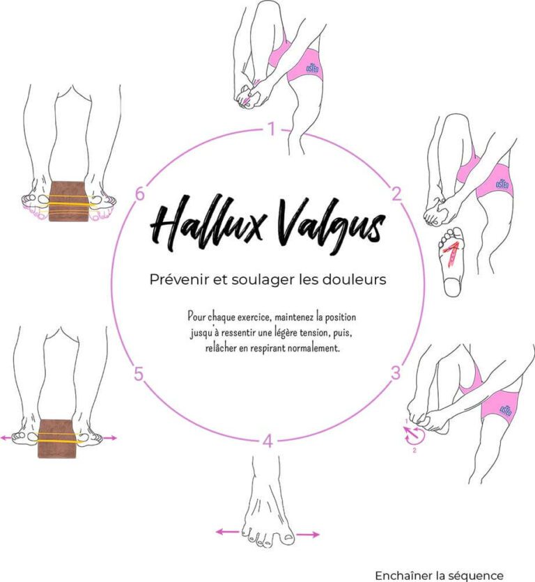 Calmer ses douleurs d'Hallux Valgus par des exercices d'ostéopathe