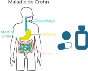 Maladie de Crohn - Le soulager par des exercices d'ostéopathie