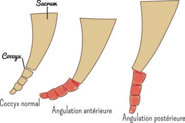 Douleur au coccyx - La soulager avec exercices d'ostéopathe