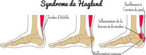 Syndrome de Haglund - La soulager avec exercices d'ostéopathe