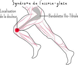 Syndrome de l'essuie-glace - Le calmer par des exercices d'ostéo