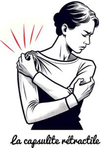 8 choses à savoir sur la capsulite rétractile de l'épaule - Ostéopathe ...