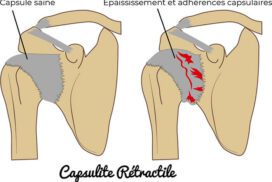 Capsulite rétractile - Des exercices efficaces d'ostéopathe