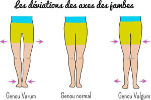 Gonarthrose - Des exercices efficaces d'ostéopathe