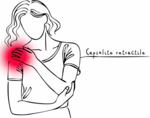 Capsulite rétractile - Des exercices efficaces d'ostéopathe
