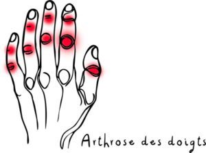 Arthrose des doigts - Des exercices efficaces d'ostéopathe